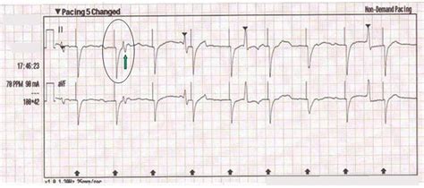 Transcutaneous Pacing Tcp The Problem Of False Capture