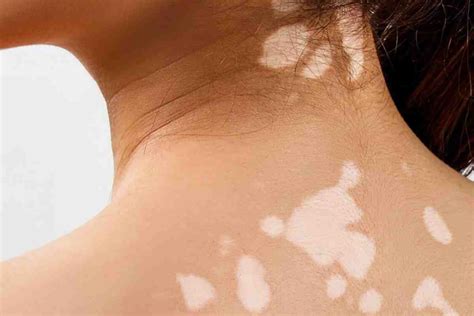 Як прибрати пігментні плями на спині