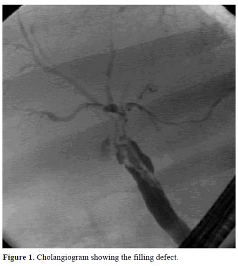 Successful Diagnosis And Management Of Biliary Cast Syndrome In A