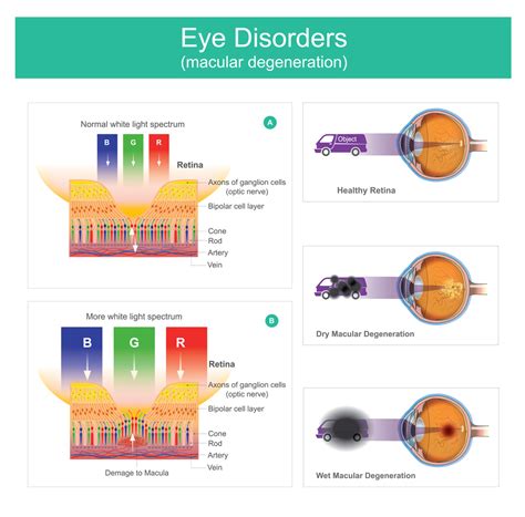 Macular Degeneration Stages What Stage Are You In Why Do You Need To