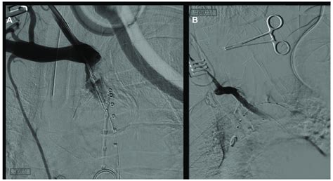 A Completion Angiogram Showing Lesion Predilation With A 5 Mm