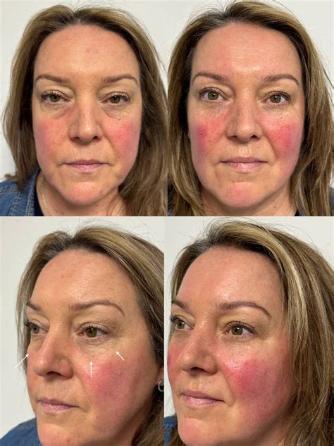 Facial Aesthetics Before And After Dr Andrew Culbard