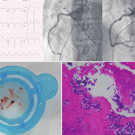A It Shows The 12 Lead Electrocardiogram With St Elevation In Leads Download Scientific