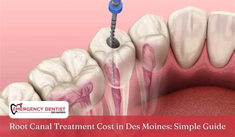 Root Canal Treatment Cost In Des Moines Simple Guide