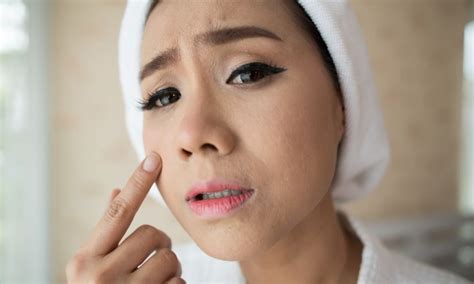 Gak Bikin Kantong Jebol Sulap Wajah Bopeng Dengan Minyak Ajaib Ini Mulus Bak Model Iklan