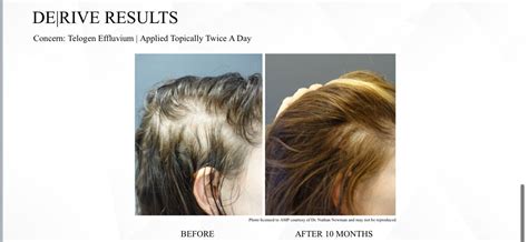 Exosomes For Hair Loss — Primemed Ca