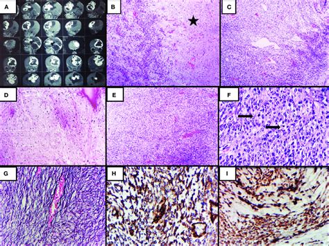 A Left Frontoparietal Complex Solid Cystic Intensely Enhancing Lesion