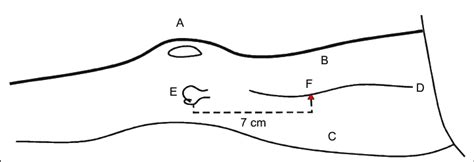 Shows Line Diagram Of Lateral Approach To The Popliteal Block Download Scientific Diagram