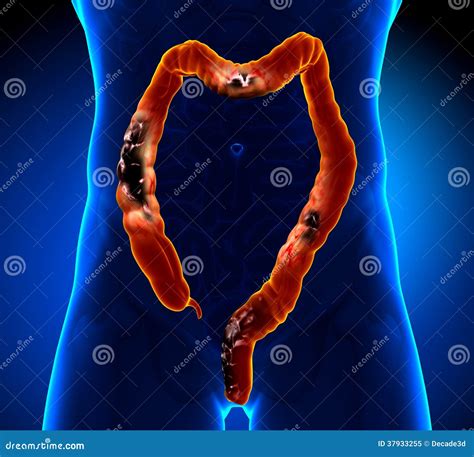 Colorectal Cancer And Polyp Stock Illustration Illustration Of Blue