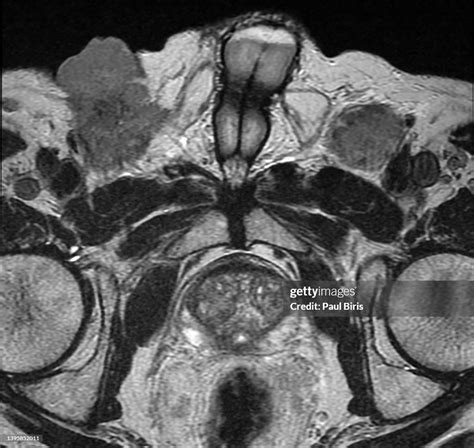 Inguinal Lymphadenopathy Swollen Lymph Nodes In Groin Seen On Mri Axial