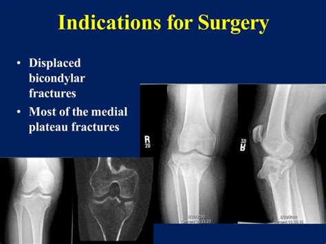 Proximal Tibia Fractures And Its Management Pptx