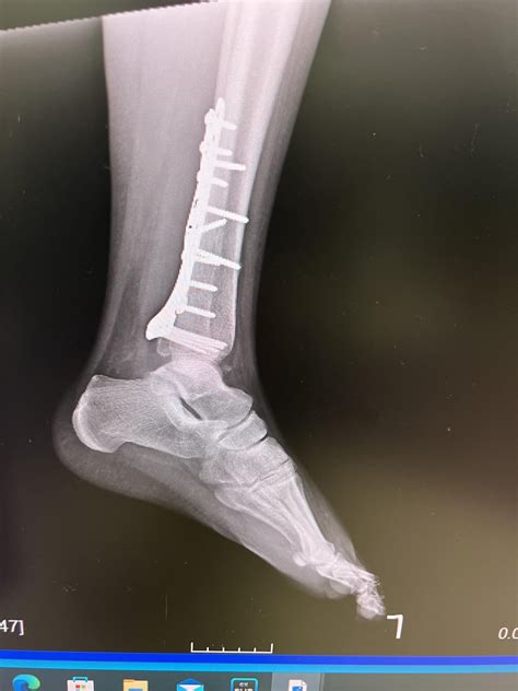 8 Weeks Post Op Ankle Orif R Orif