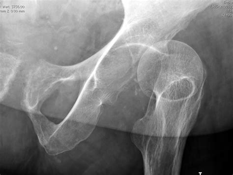 Hüftluxation Doccheck