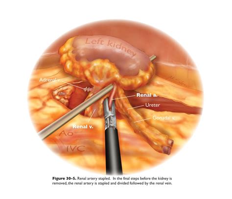 Nephrectomy Silver Medical Visuals