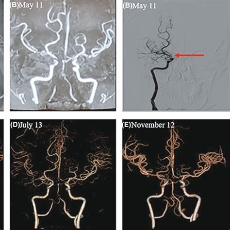 Cerebral Vascular Imaging Before And After This Onset A Mra Before