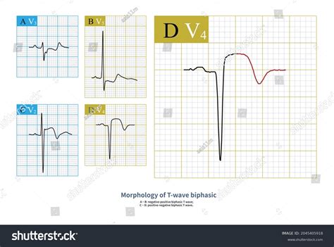 T Wave Biphasic Includes Positive Negative Biphasic Stock Illustration