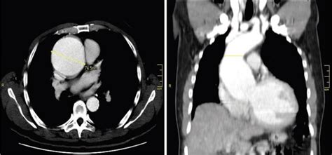 Challenging The Management Of Bleeding And Coagulopathy In Ascending