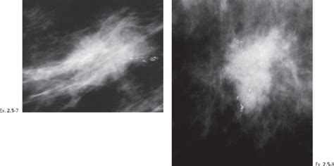The Evolution Of Casting Type Calcifications Oncohema Key
