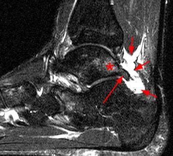 Posterior Ankle Impingement Radsource