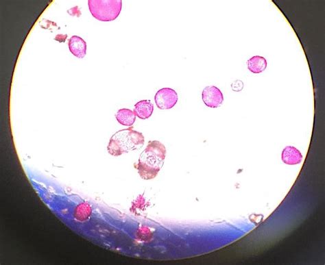 Manic Monday Tree Pollen Levels Extreme Today In The Delaware Valley Asthma Center