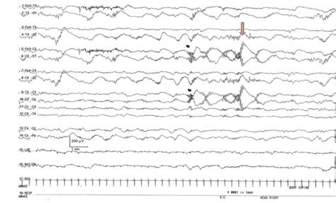 Premature Electroencephalography Lama Alzahrani