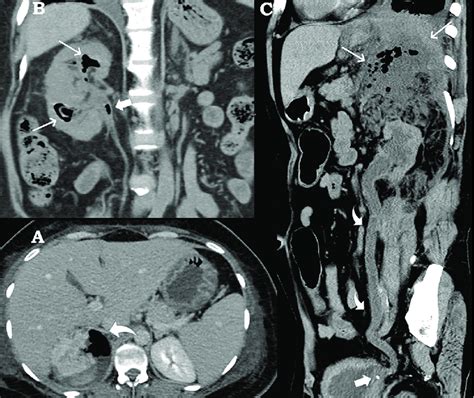 A Emphysematous Pyelonephritis Axial Computed Tomography Ct In The Download Scientific
