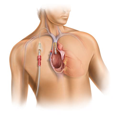 The High Flow Port Designed And Indicated For Apheresis Powerflow™ Implantable Apheresis Iv Port