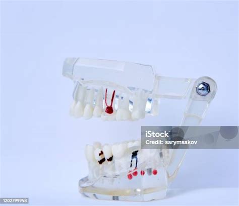 치과 의사 치아 플라스틱 모델 교수에 대 한 나사 임 플 란 트 학습 및 치아와 잇 몸을 보여주는 치과 사무실에서 환자 0명에 대한 스톡 사진 및 기타 이미지 Istock