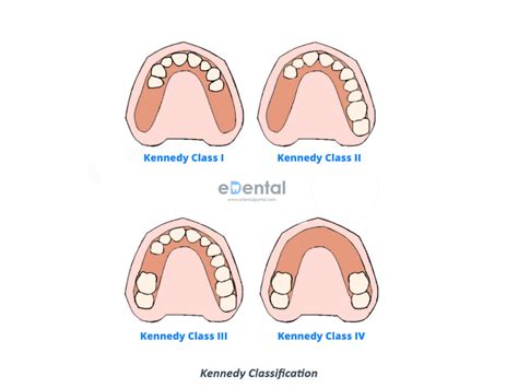 Kennedy S Classification Of Removable Partial Denture Design Talk