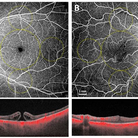 Widefield OCTA Scans 12 12 Mm Of Superficial Capillary Plexus A Download Scientific