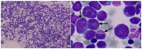 Bone Marrow Smear With Hypercellular Dysplastic Monocytes And
