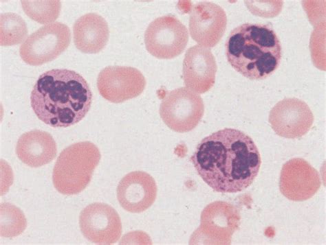 核右移 实验诊断学