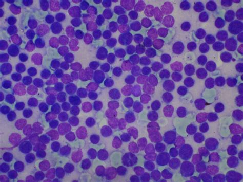 Aspiration Smear Showing Monomorphic Population Of Atypical Lymphoid