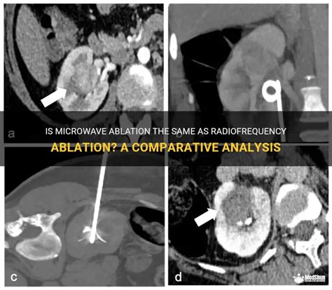 Is Microwave Ablation The Same As Radiofrequency Ablation A Comparative Analysis Medshun
