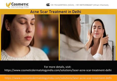 Ppt Acne Scar Treatment In Delhi Powerpoint Presentation Free