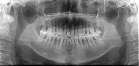 Post Operative Panorama Image Left Styloid Process Tip Was Removed