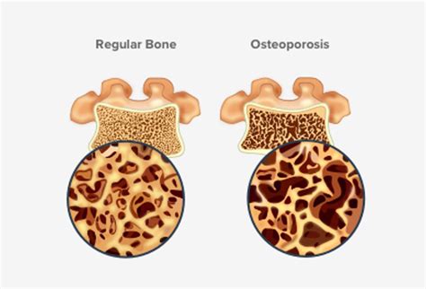 Symptoms Of Osteoporosis Of The Spine Huffman Spine Clinic Osteoporosis
