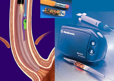 Bravo For Reflux Monitoring Manchester Gastro Specialists