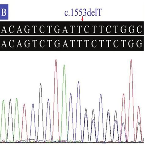 Sequence Analysis Of The P F518sfs 4 Mutation In The Phex Gene Dna Download Scientific