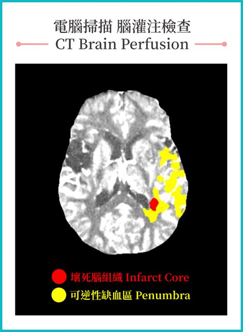 Ct Brain Perfusion After Ischaemic Stroke 聖德肋撒醫院 掃描部 St Teresas Hospital Scanning Department
