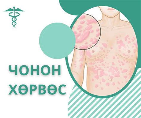🚨Чонон хөрвөс буюу Эффект эмнэлэг Effect Clinic Facebook