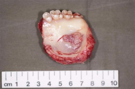Partial Maxillectomy Download Scientific Diagram