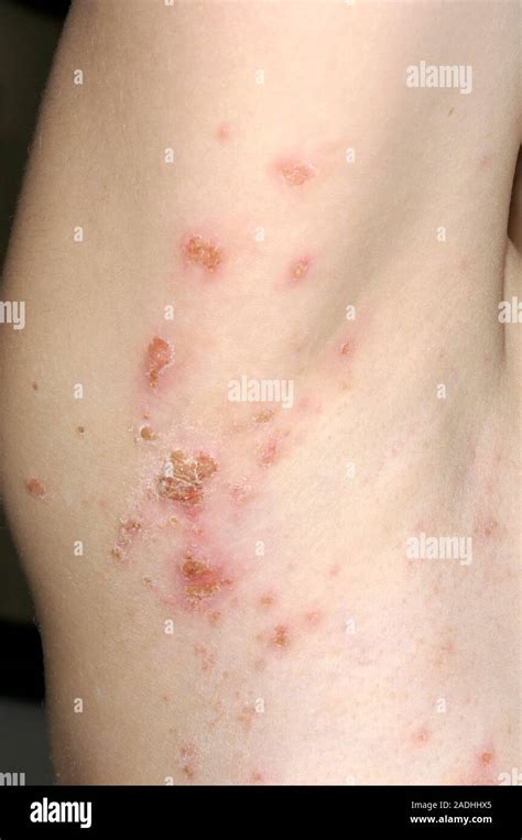 Bacterial Skin Infection Armpit