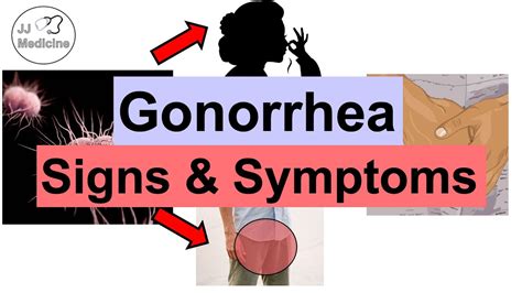 Gonorrhea Signs And Symptoms And Complications And Why They Occur Youtube