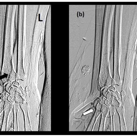 Angiogram Of The Left Upper Limb A Demonstrating Reduced Flow In The