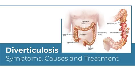 Diverticulitis Vs Diverticulosis
