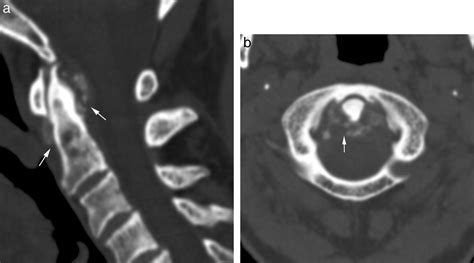 La Columna Cervical Degenerativa Radiología