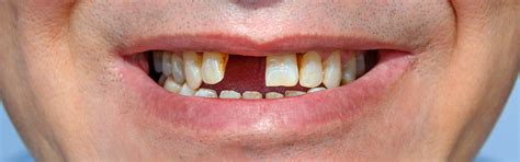 How To Hide A Missing Front Tooth Tips And Tricks Blog