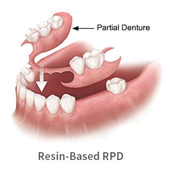 Mandibular Partial Denture Resin