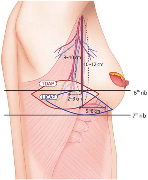 Flap Design And Range Of Locations For The Sixth Lateral Intercostal